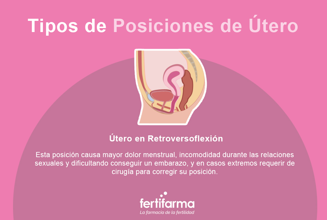 Útero en Anteversión. Causas, Síntomas y Tratamiento